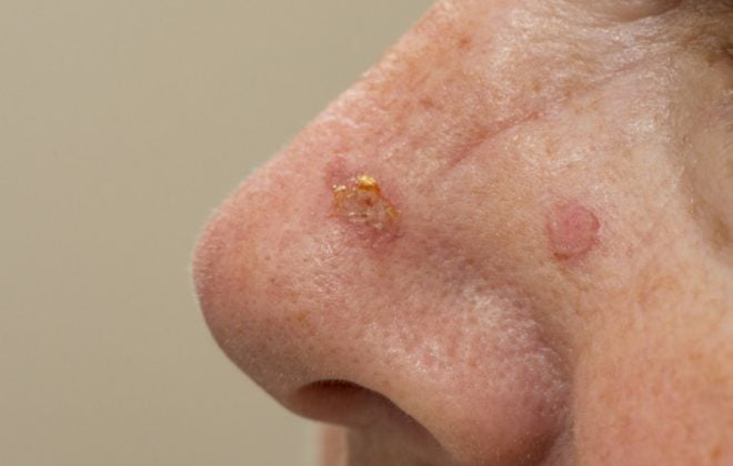 Rimedi naturali per la cheratosi attinica - Derma-Point