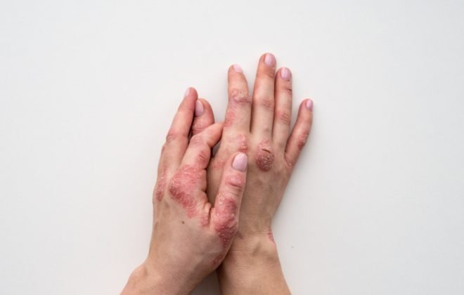 Cos’è la Psoriasi da stress? - Derma-Point