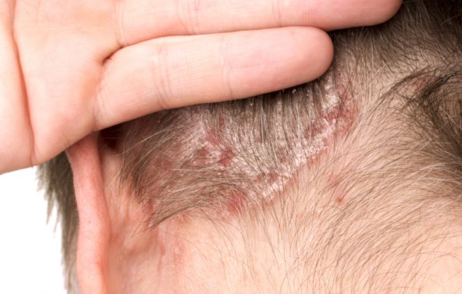 Psoriasi alle mani: cos’è e come si cura - Derma-Point