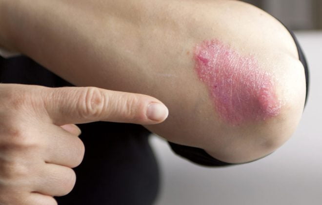 Psoriasi alle unghie: cos’è, sintomi e come curarla