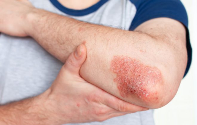 Psoriasi del cuoio capelluto: sintomi e rimedi- Derma-Point
