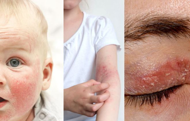 Dermatite atopica contorno occhi: sintomi e cura- Derma-Point