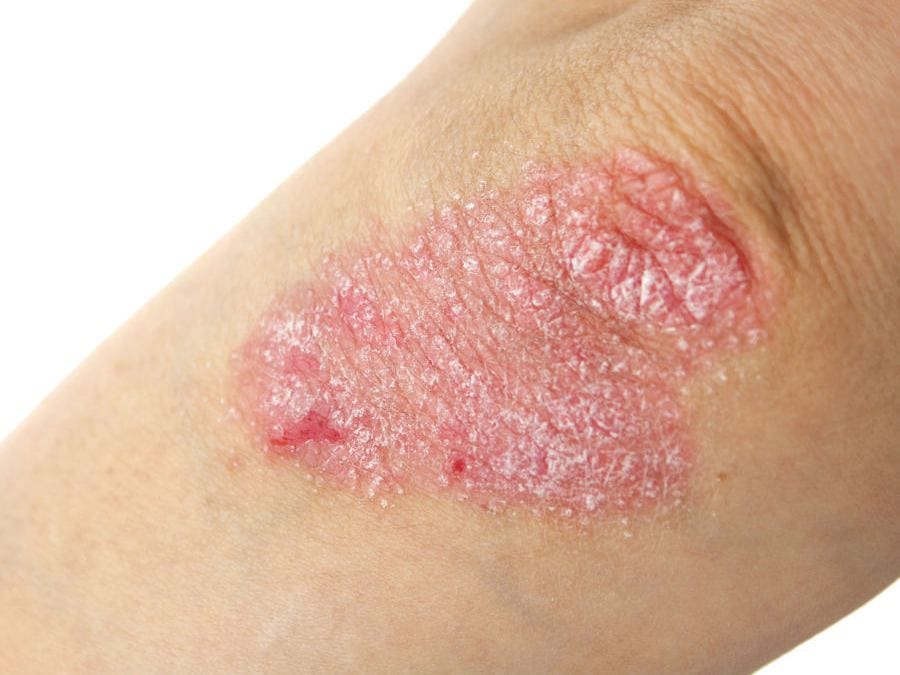 Psoriasi del gomito - Derma-Point