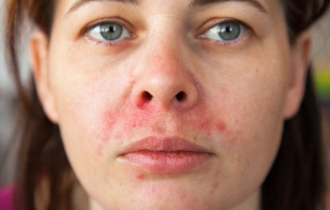 Cos'è la dermatite atopica nummulare - Derma-Point