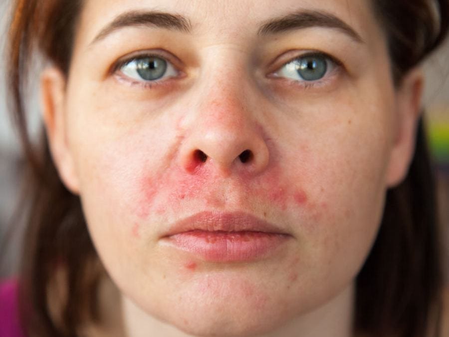 Dermatite atopica sul viso: cause, sintomi e rimedi- Derma-Point