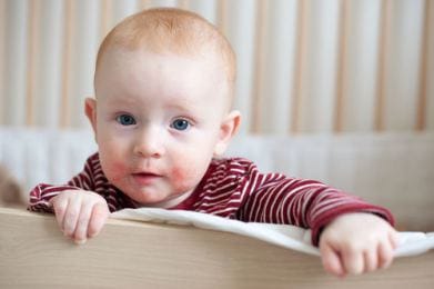 Dermatite atopica sul viso: cause, sintomi e rimedi- Derma-Point