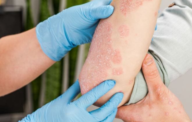 Cosa significa psoriasi volgare - Derma-Point