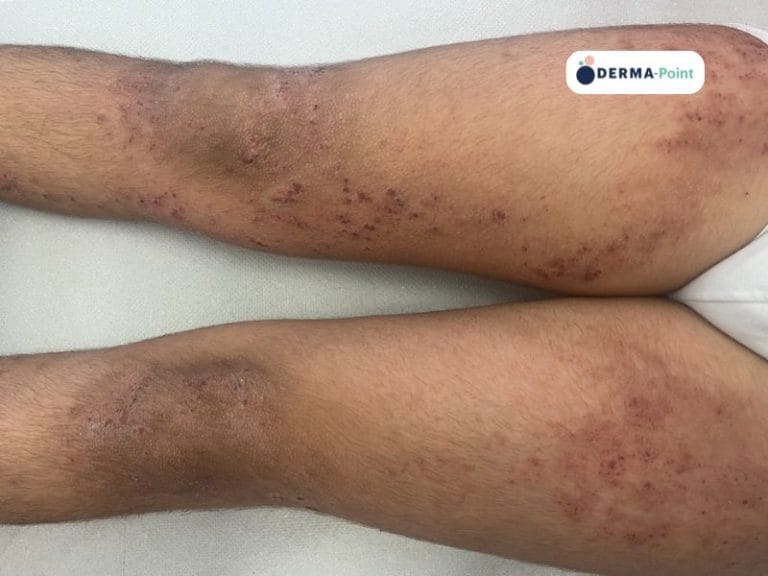 Dermatite atopica sulle mani: cause e rimedi- Derma-Point