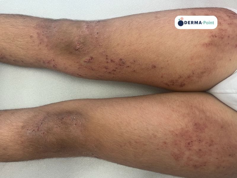 Dermatite atopica contorno occhi: sintomi e cura- Derma-Point