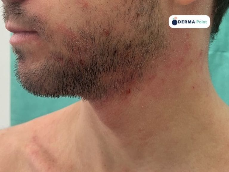 Dermatite Atopica: cos'è, sintomi e cure- Derma-Point