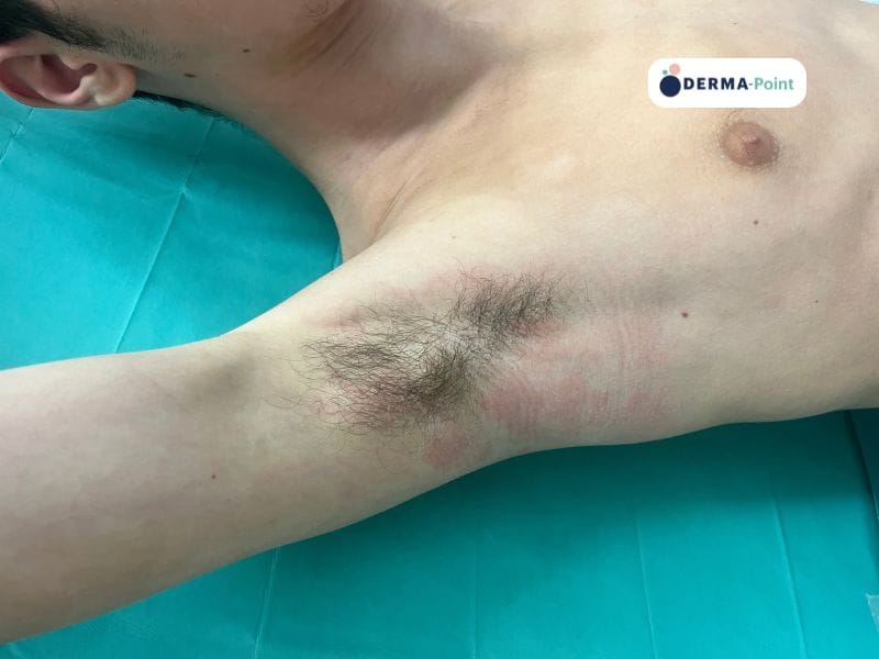 Dermatite Atopica: cos'è, sintomi e cure- Derma-Point