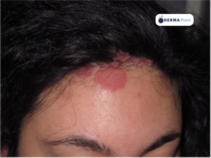 Psoriasi alle mani: cos’è e come si cura - Derma-Point