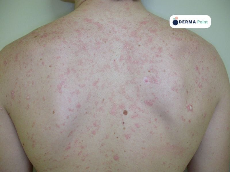 Psoriasi guida alla crema idratante- Derma-Point