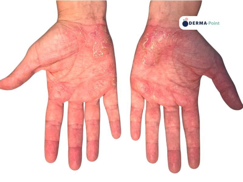 Psoriasi alle mani: cos’è e come si cura - Derma-Point